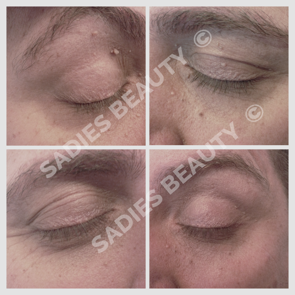 Advanced Cosmetic Procedures - Sadie's Beauty